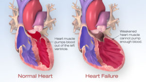 symptoms of heart failure – Cardiac Wellness Institute